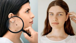 Mole Astrology: Moles on the Body and Their Importance - AstroLive Blog